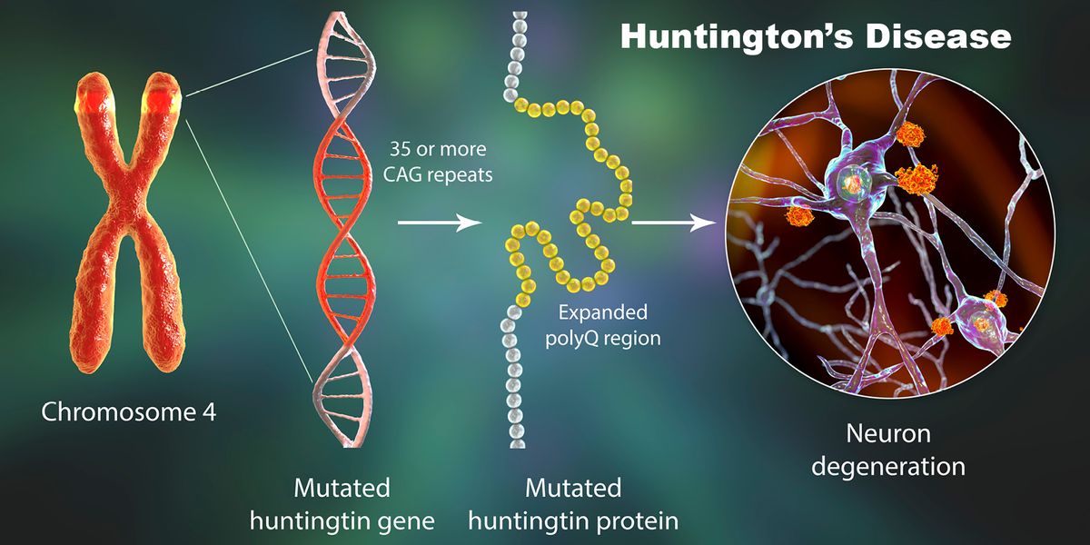 Gene Therapy Slows Huntington's Disease Progression by 75% in Landmark ...