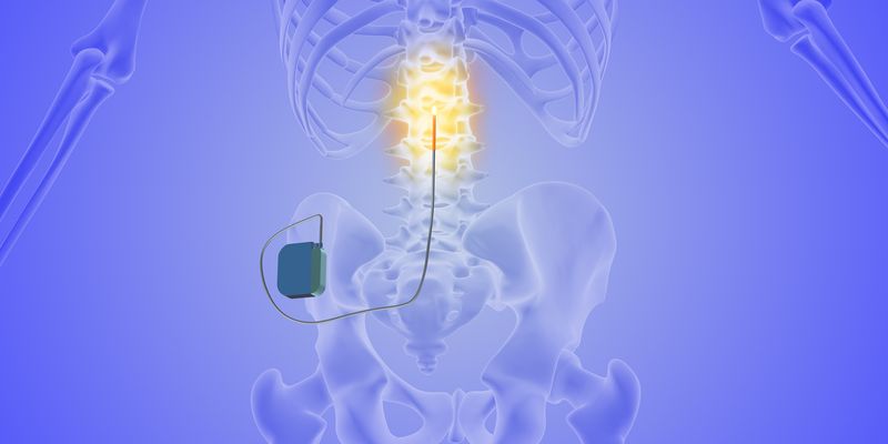 A reengineered spinal cord stimulator restores touch and reduces pain ...